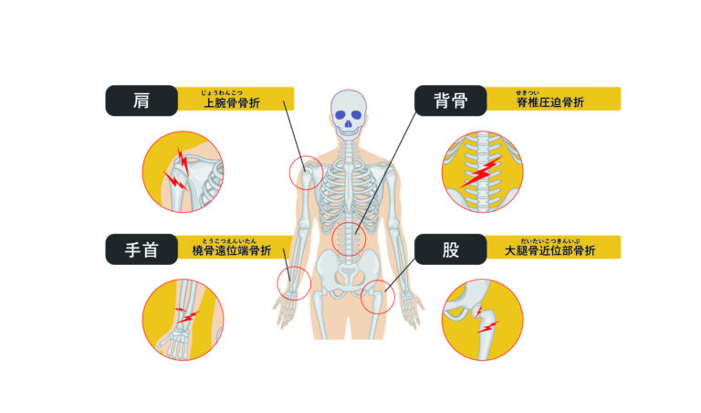 骨卒中って何？《Column vol.10》 - 株式会社Magic Shields｜高齢者の転倒骨折対策に【ころやわ】